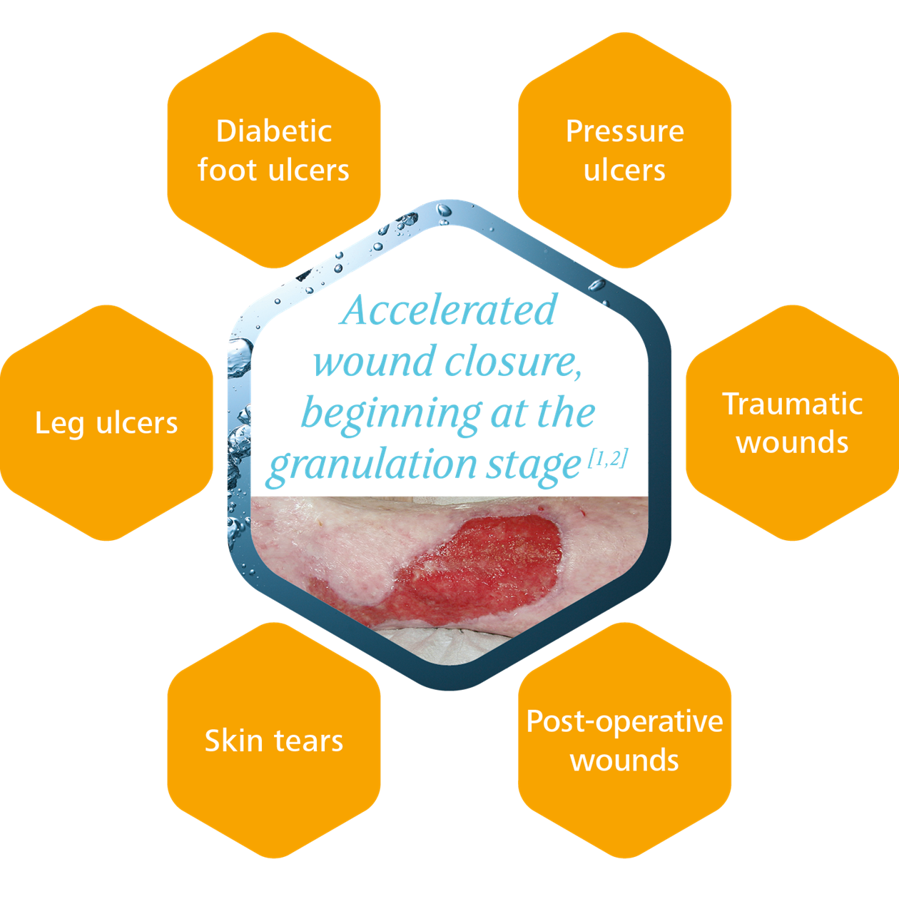 Accelerated wound closure with HydroTac®